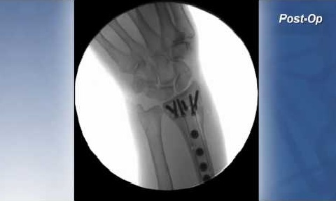 CASE STUDY Distal Radius Fracture