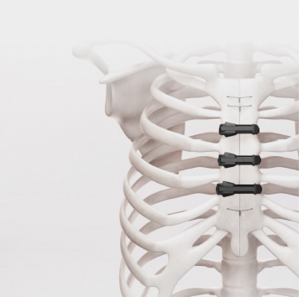 CMF & Sternal Fixation Solutions - Invibio