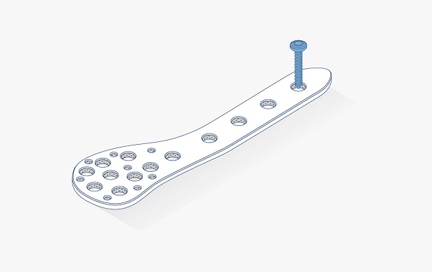 Transforming Trauma with Polymer Composites - Invibio