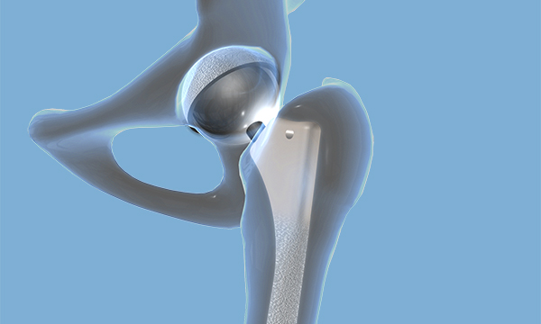 PEEK-based Devices for Hip & Knee Applications - Invibio