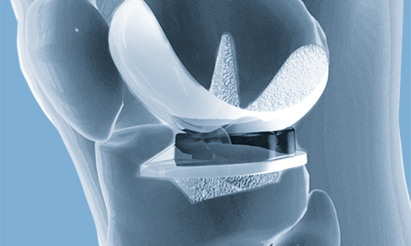 PEEK-based Devices for Hip & Knee Applications - Invibio