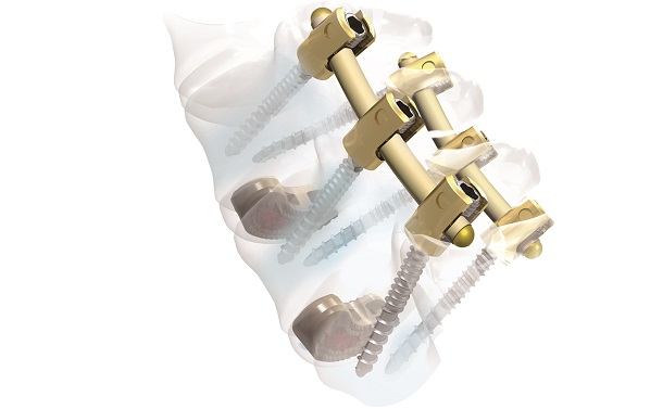 Chinas Weigao and Britains Invibio collaborate on spinal implant ...
